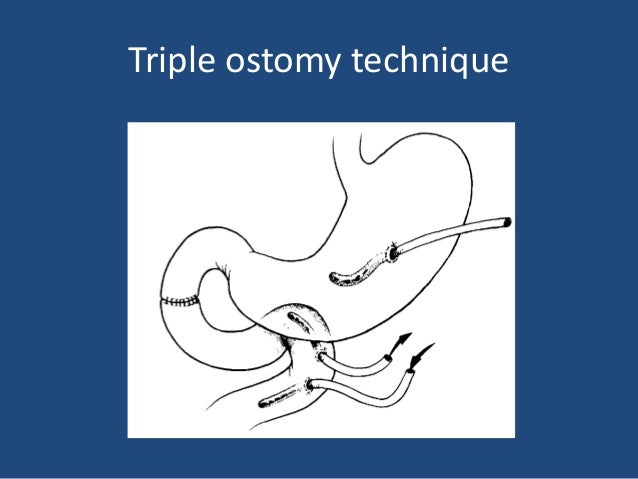 Management of duodenal trauma