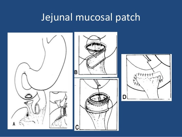 Management of duodenal trauma