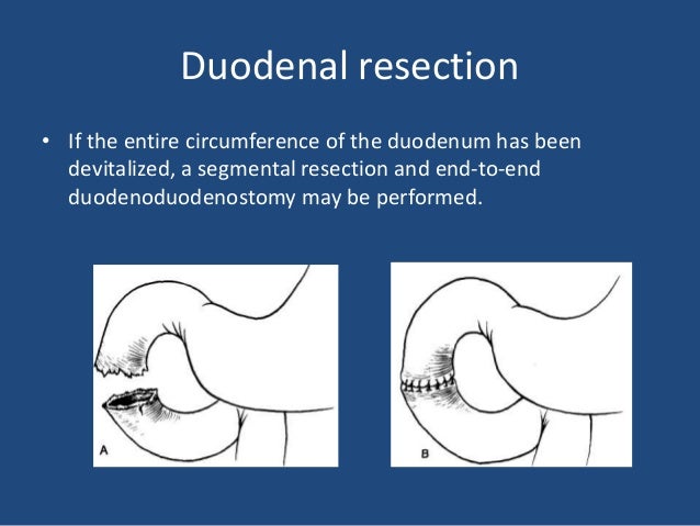 Management of duodenal trauma