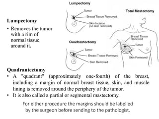 Treatment of breast cancer | PDF