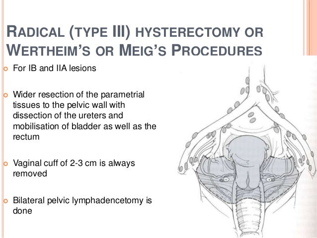 Management of Early Stage Carcinoma Cervix