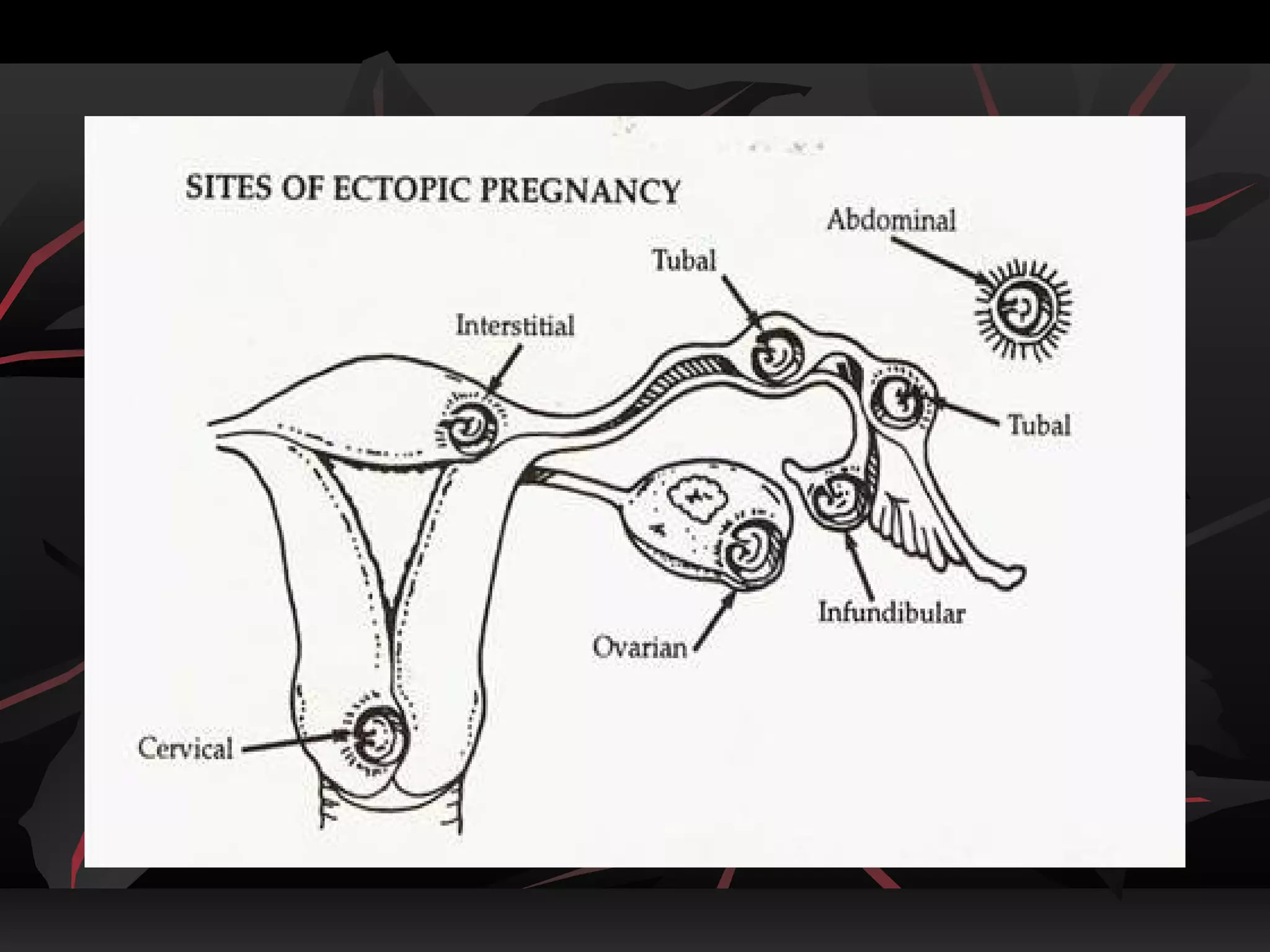 Management of ectopic pregnancy | PPT