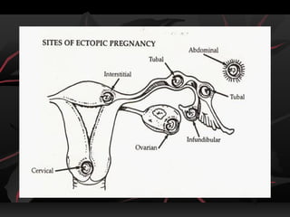 Management of ectopic pregnancy | PPT