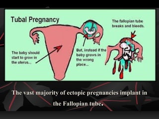 Management of ectopic pregnancy | PPT