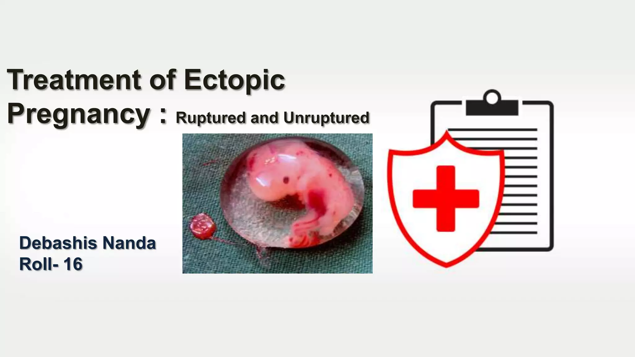 Management of ectopic pregnancy. | PPTX