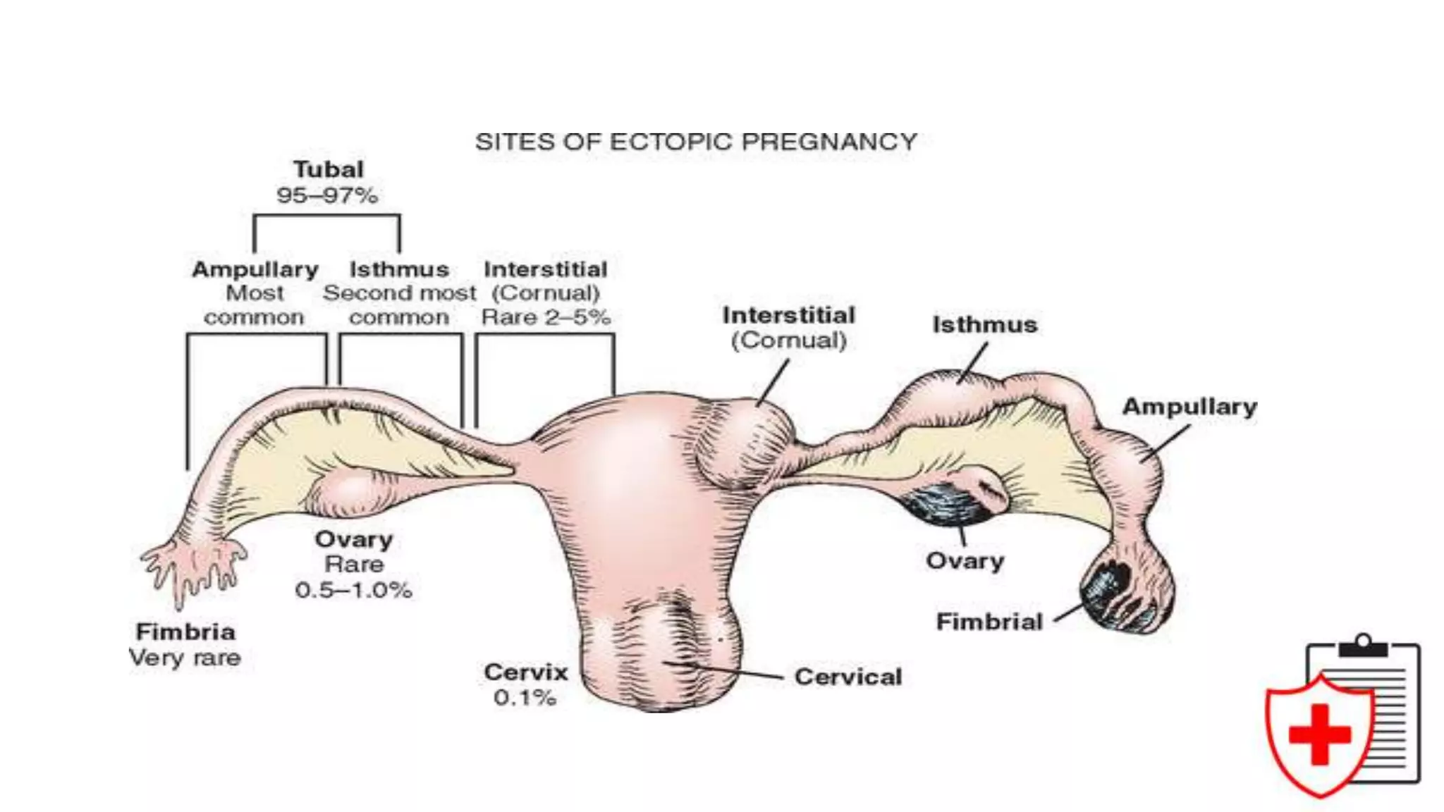 Management of ectopic pregnancy. | PPTX