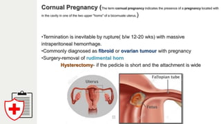 Management of ectopic pregnancy. | PPTX