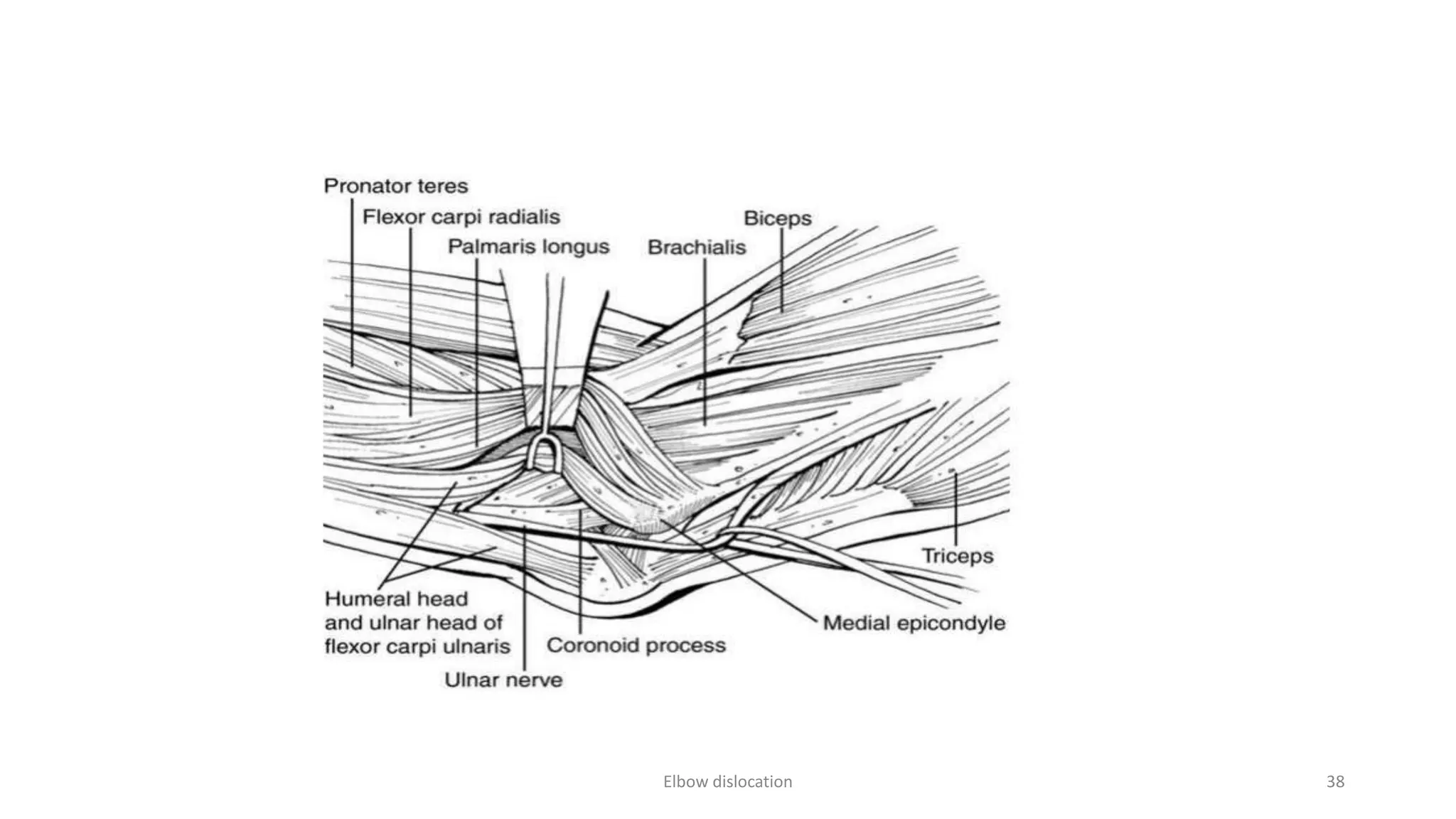 Management of Elbow Fracture Dislocation.pptx