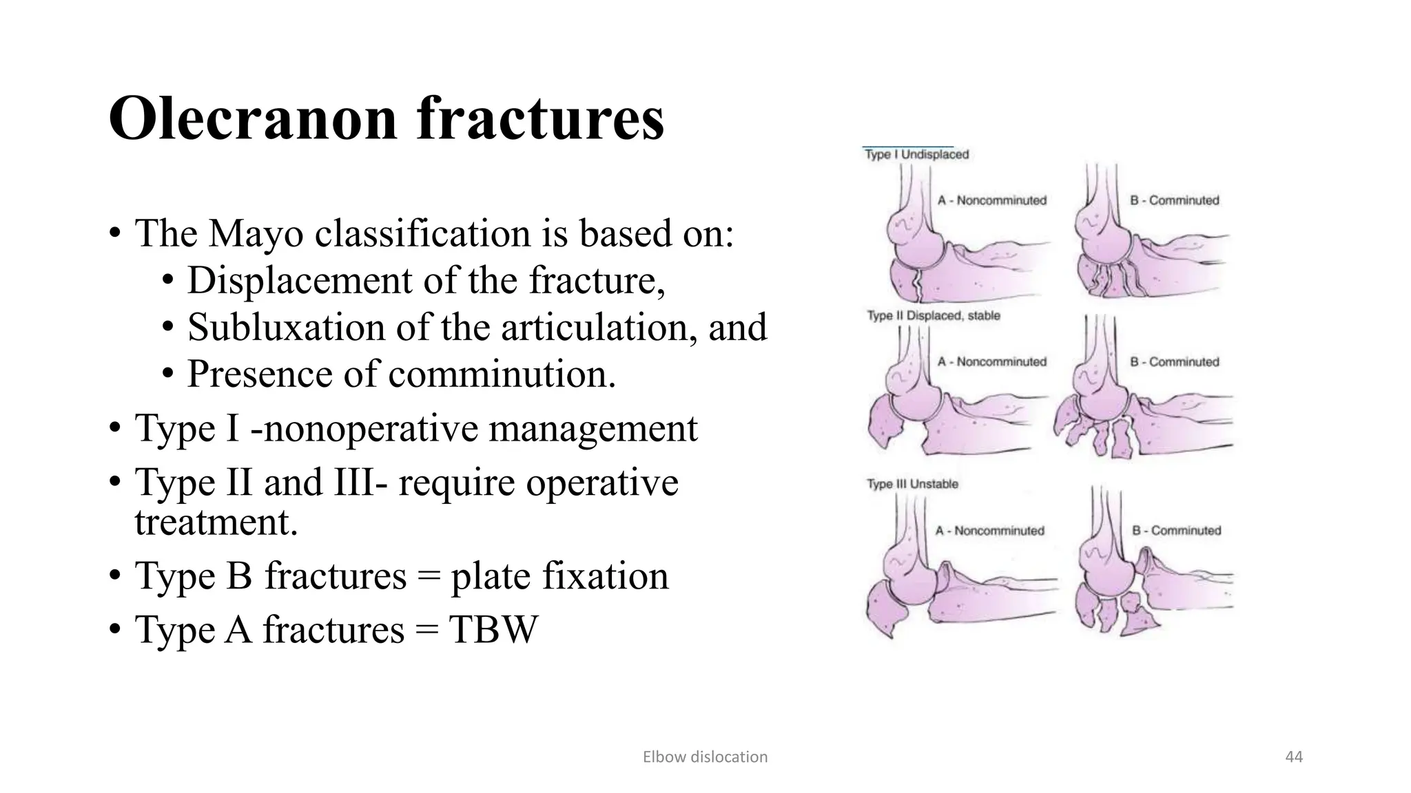 Management of Elbow Fracture Dislocation.pptx