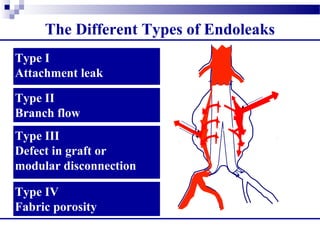 Management of endoleaks after evar asvs 2013 | PPT