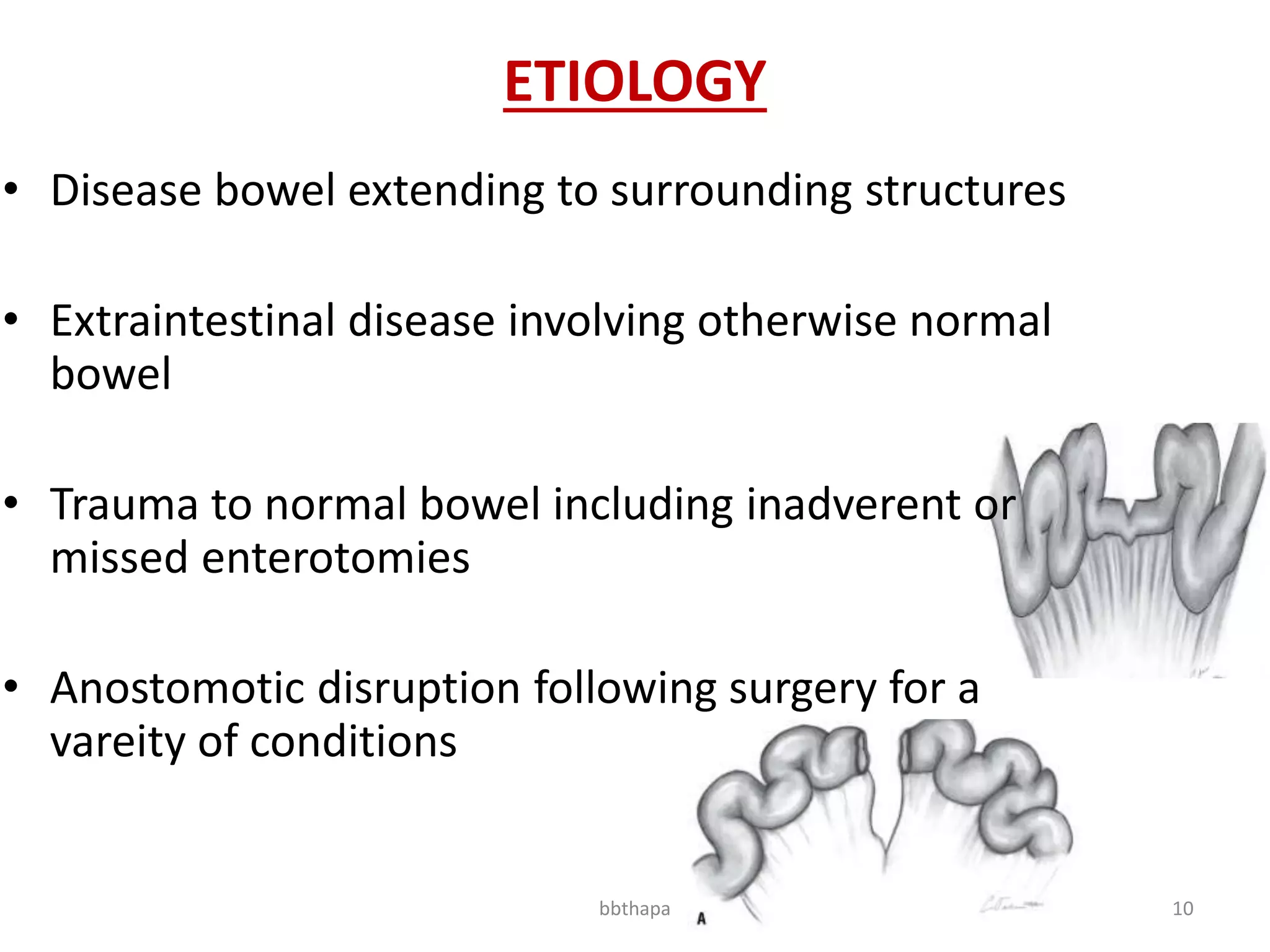 Management of enterocutaneous fistula | PPTX