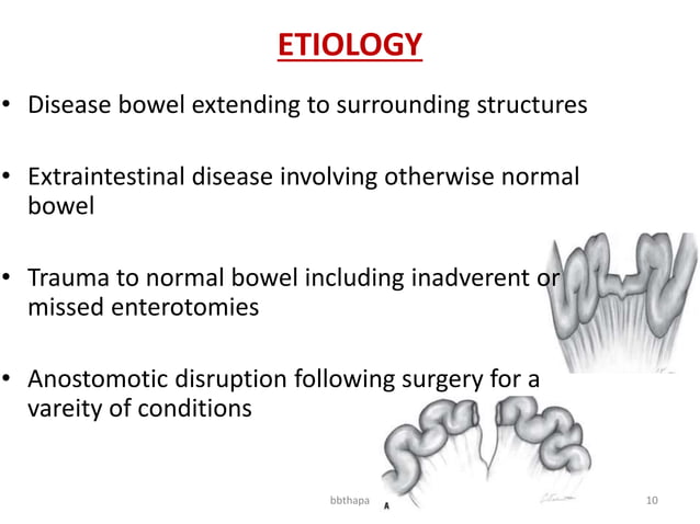 Management of enterocutaneous fistula