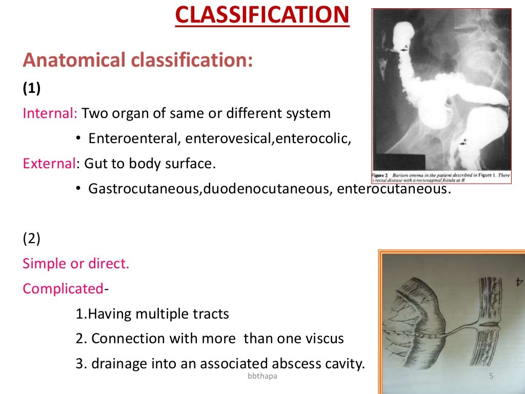 Management of enterocutaneous fistula