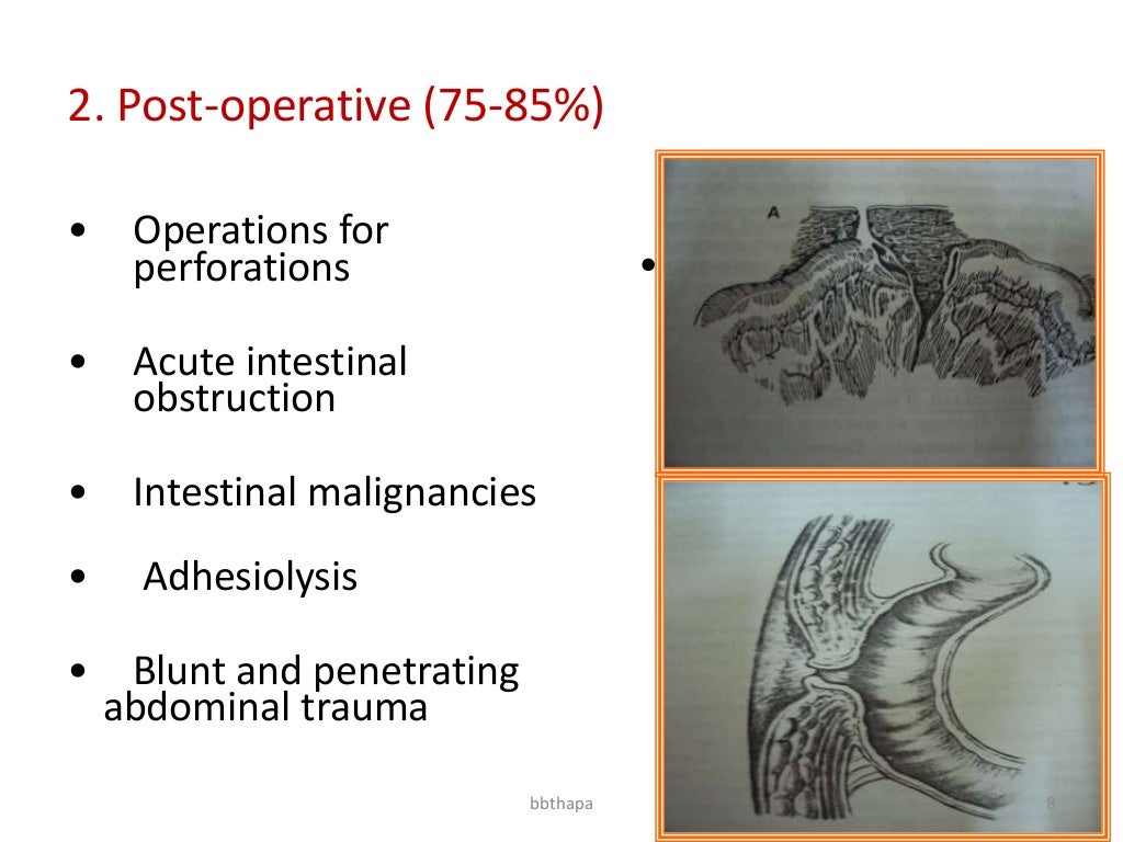 Management of enterocutaneous fistula