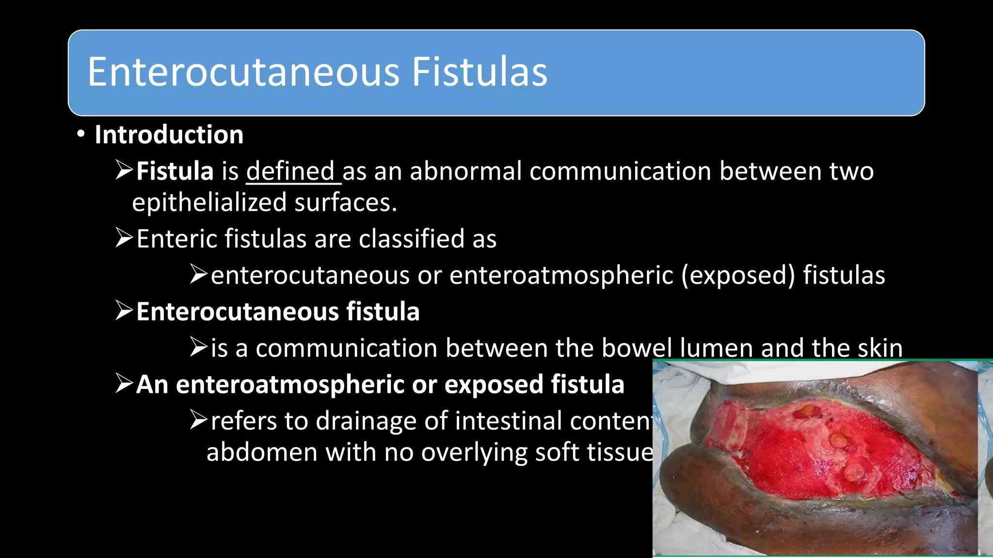 Management of enterocutaneous fistula | PPTX