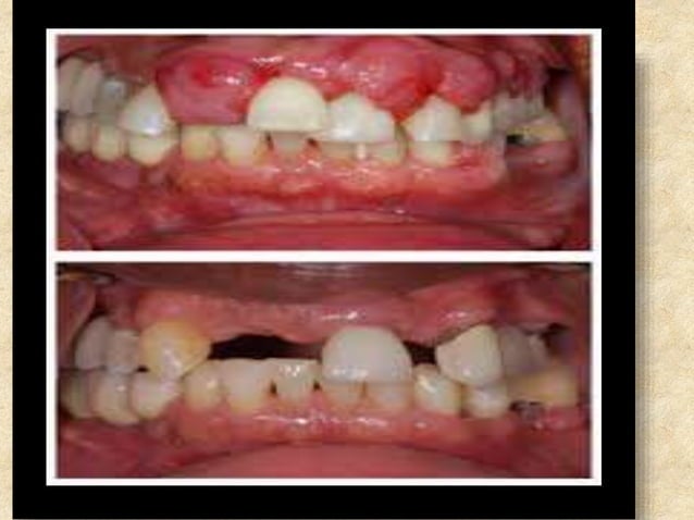 dental Management of epileptic pat.ppt | Dental Health | Diseases and ...