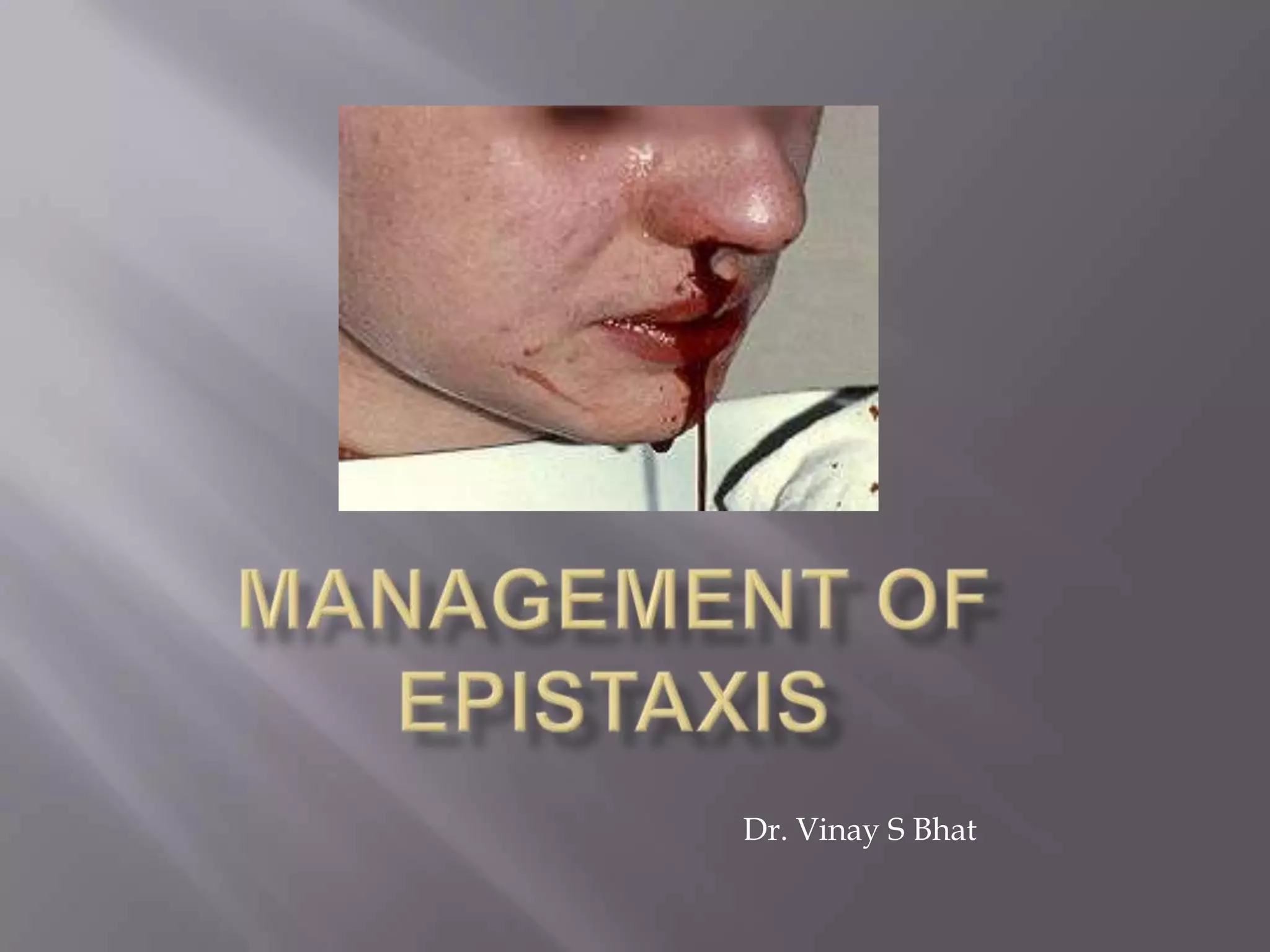 Management of epistaxis | PPTX