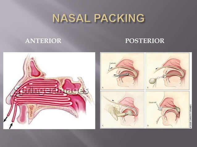 Management of epistaxis | PPTX