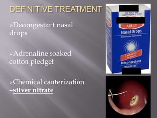 Management of epistaxis | PPTX