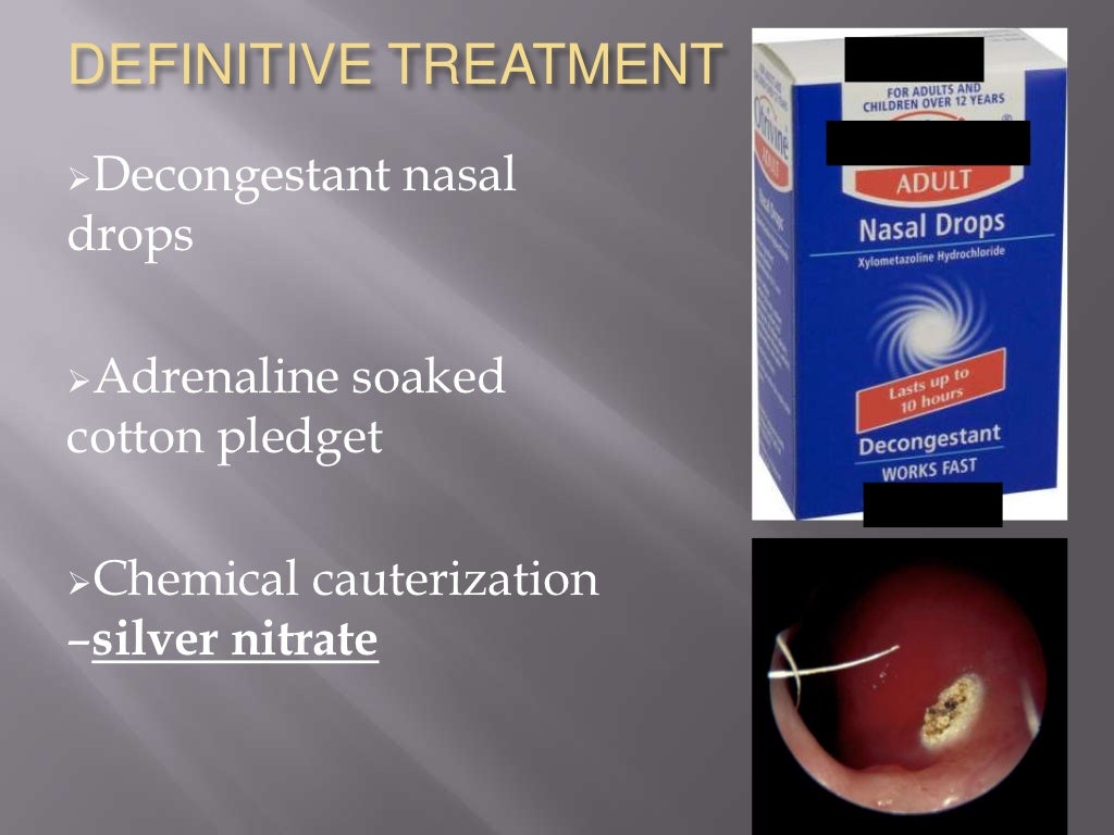 Management of epistaxis