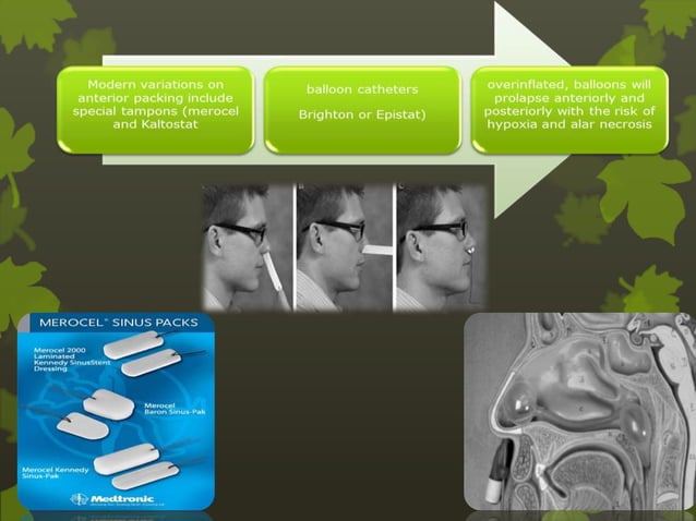 Management of epistaxis | PPTX | First Aid | Injuries