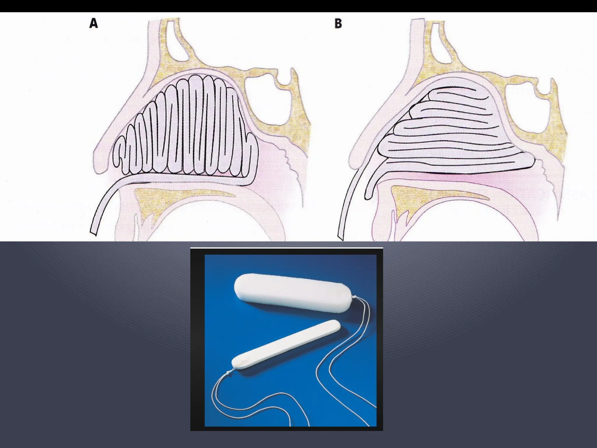 MANAGEMENT OF EPISTAXIS BY DR ANSIYA A ppt | PPTX