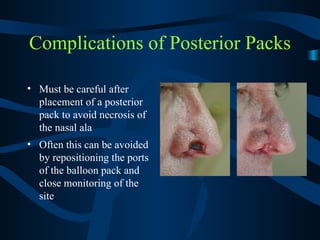 Management Of Epistaxis Goal Is Control | PPT