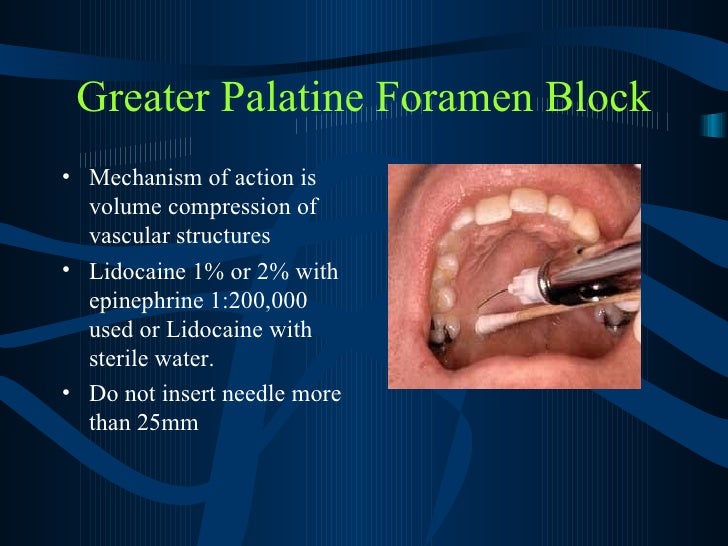 Management Of Epistaxis Goal Is Control