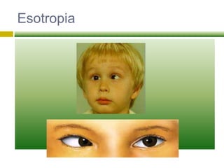 Management of esotropia.ppt