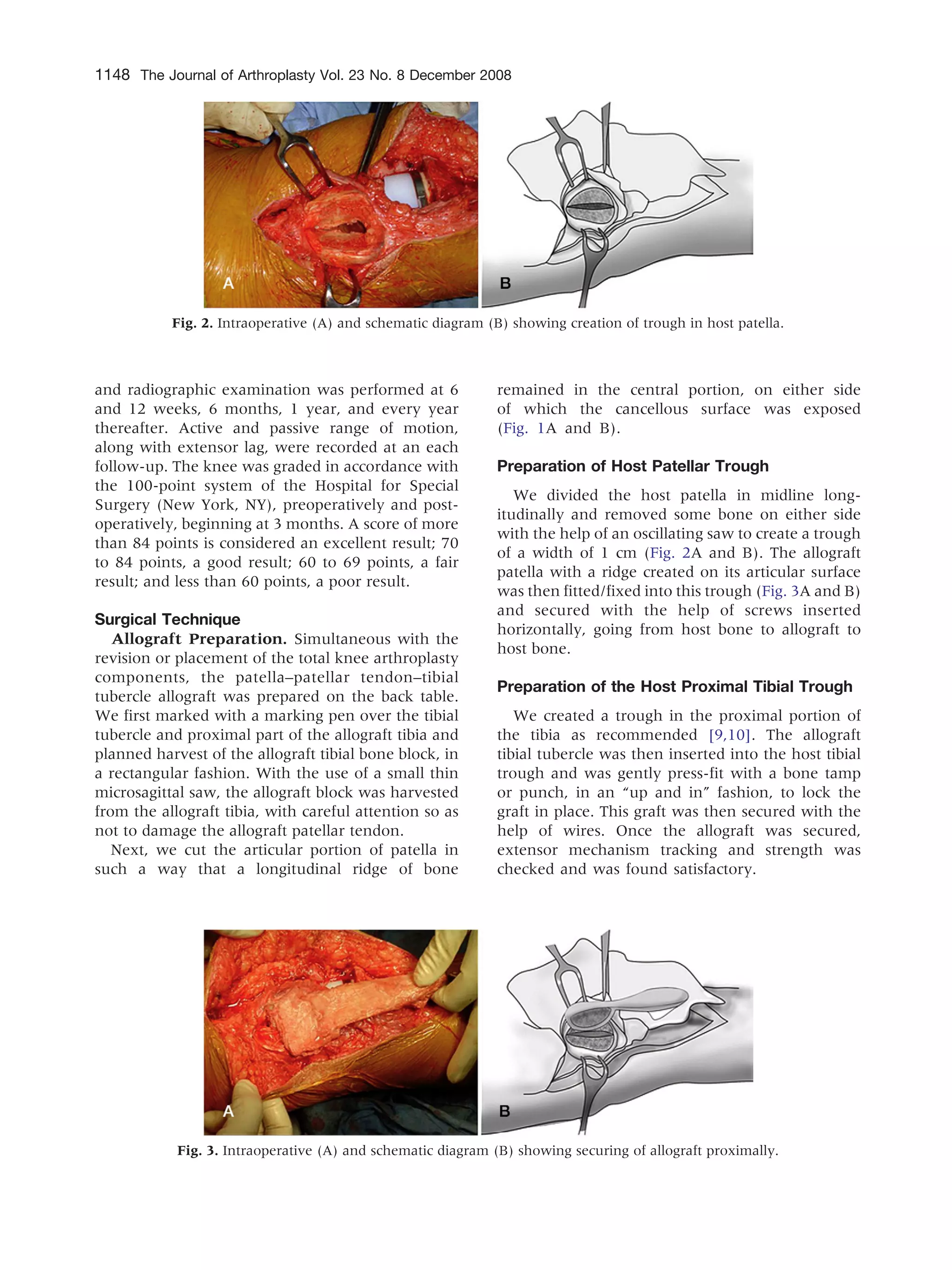 Management of extensor mechanism deficit as a consequence of patellar ...
