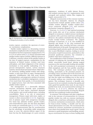 Management of extensor mechanism deficit as a consequence of patellar ...