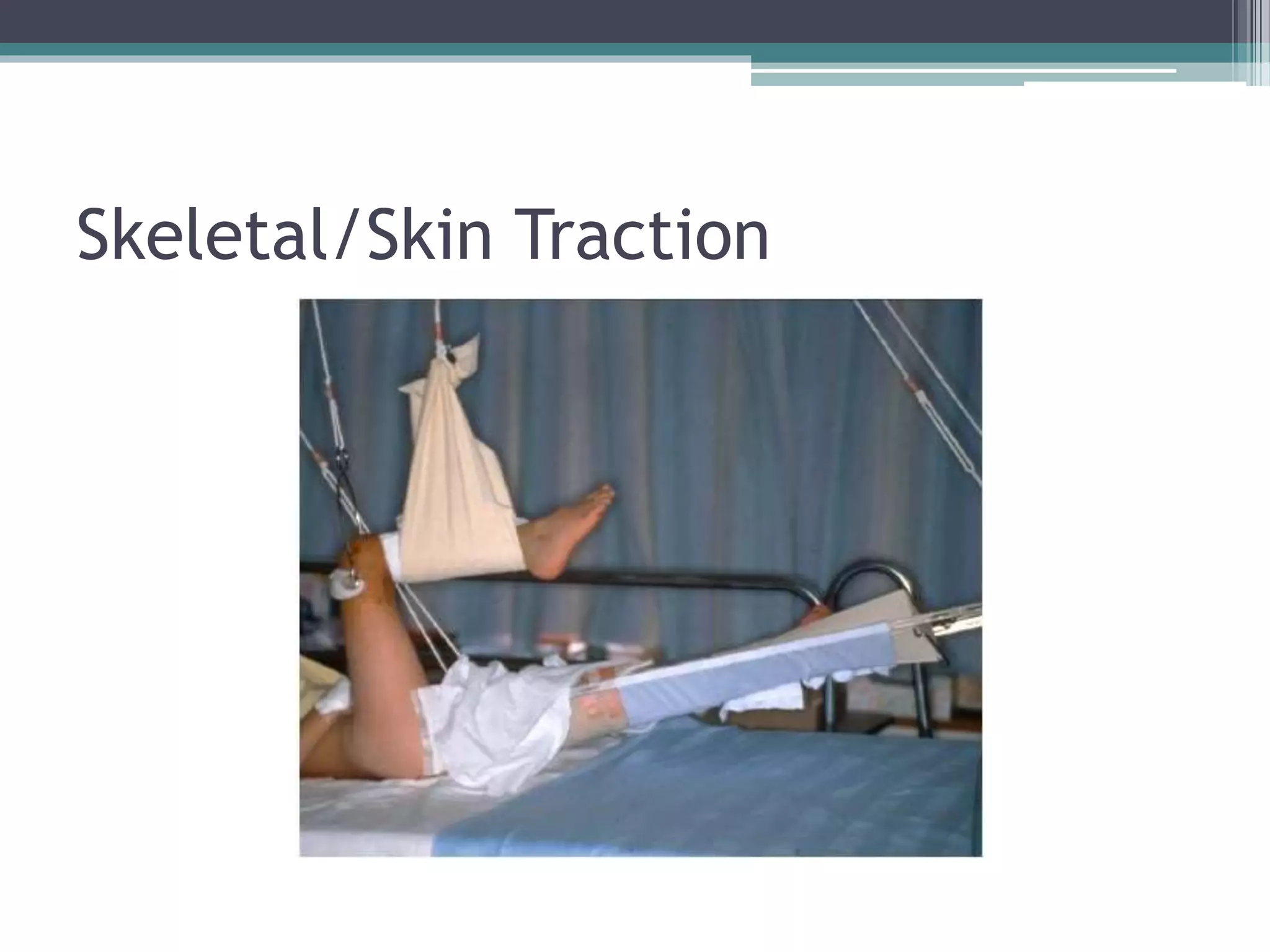 Management of Femur in Pediatric Group Age.pptx