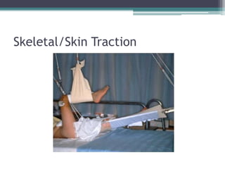 Management of Femur in Pediatric Group Age.pptx