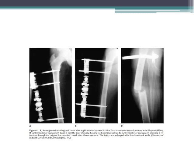 Management of Femur in Pediatric Group Age.pptx