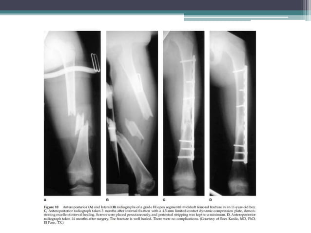 Management of Femur in Pediatric Group Age.pptx