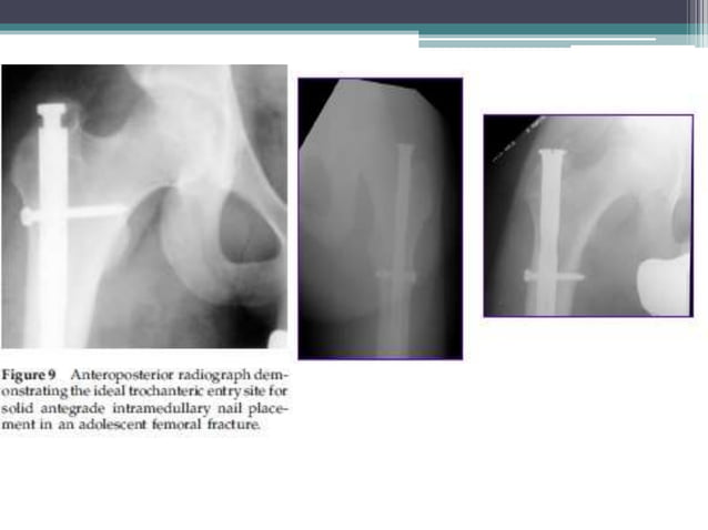 Management of Femur in Pediatric Group Age.pptx