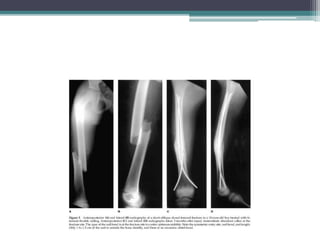 Management of Femur in Pediatric Group Age.pptx
