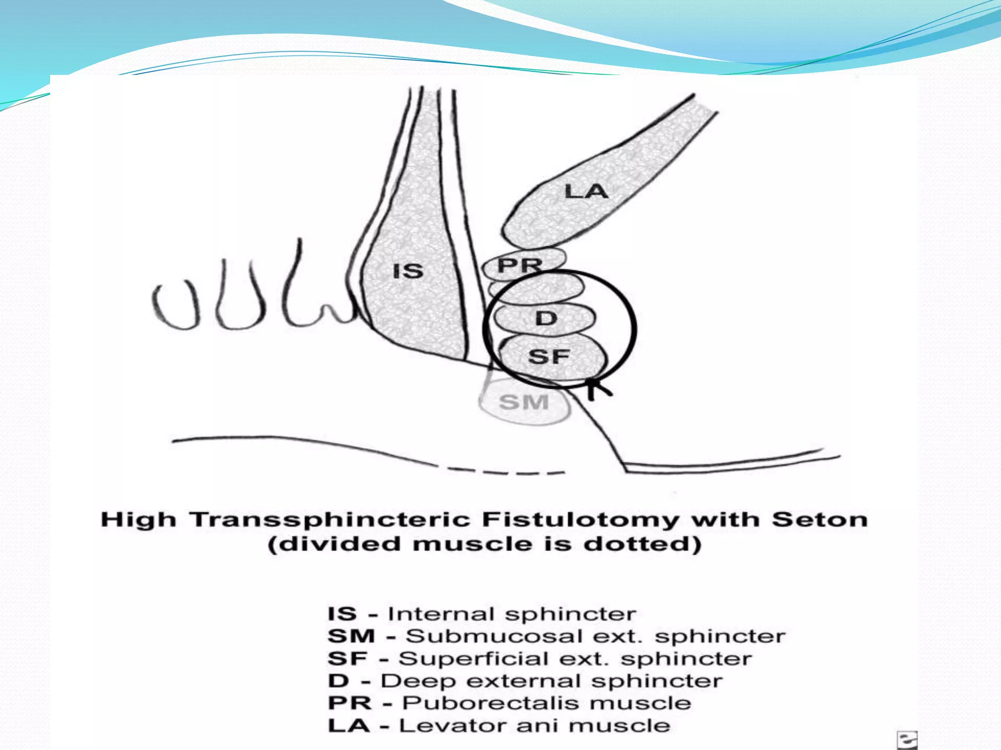 Management of fistula of ano. | PPTX