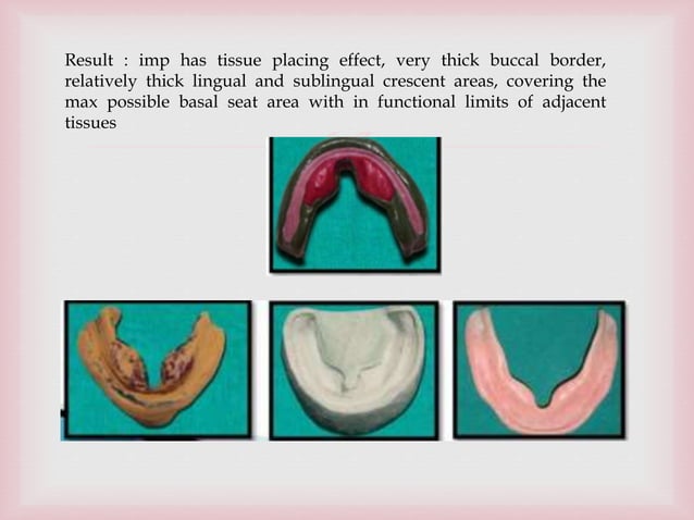 flat ridge management .pptx | Dental Health | Diseases and Conditions