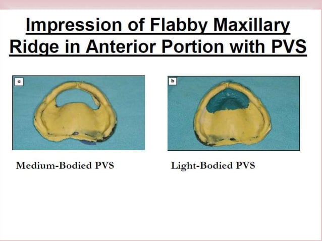 flat ridge management .pptx | Dental Health | Diseases and Conditions