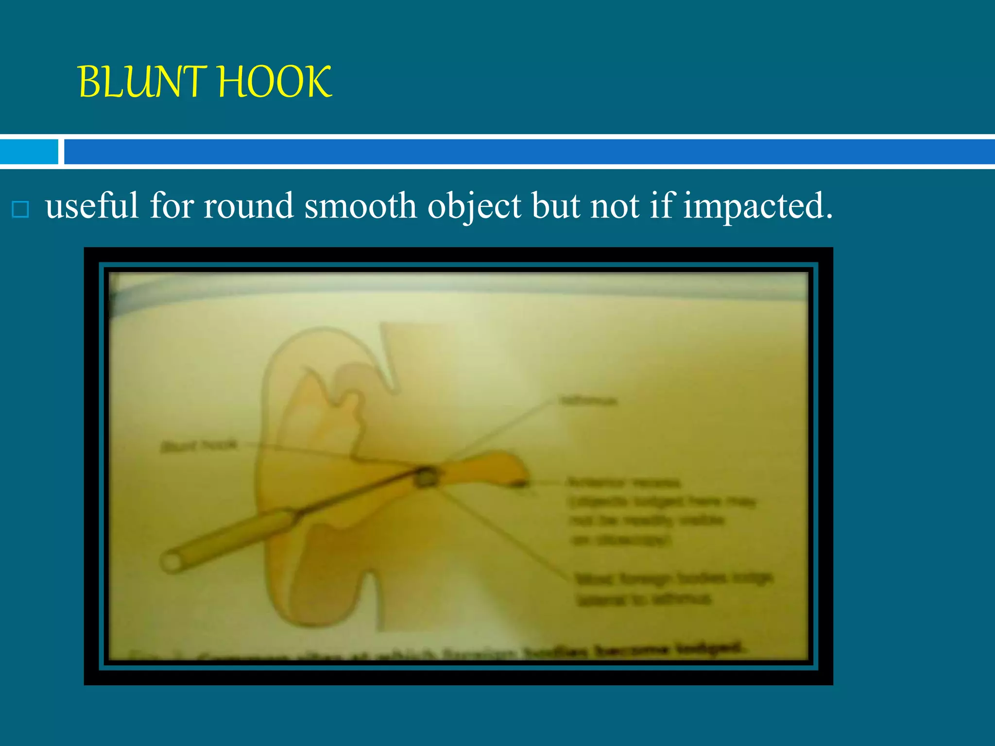 Management of foreign body in ear | PPTX