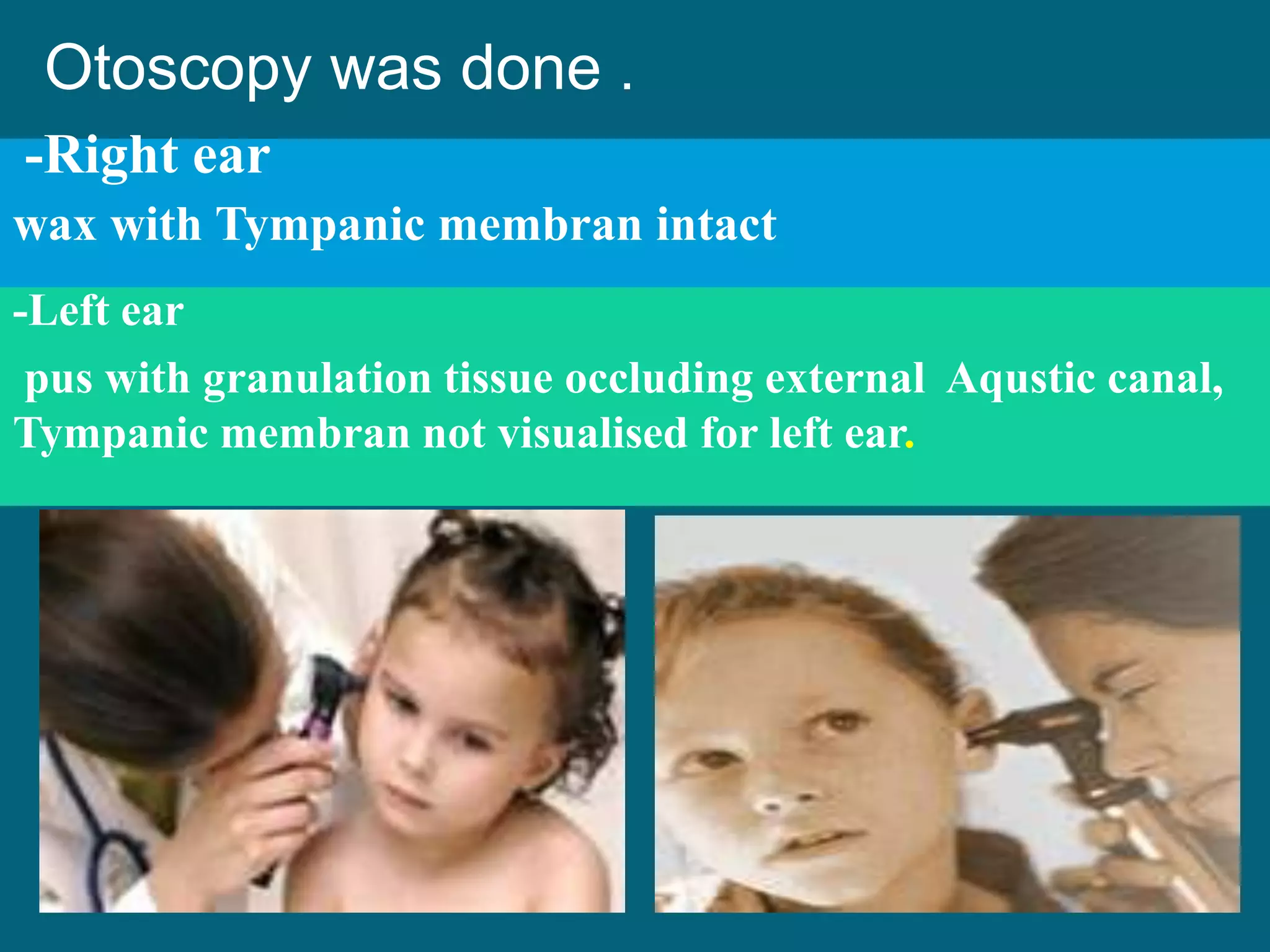 Management of foreign body in ear | PPTX