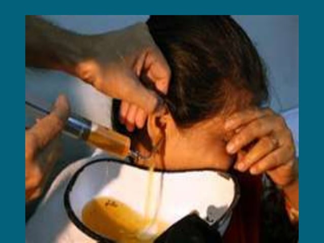 Management of foreign body in ear | PPTX