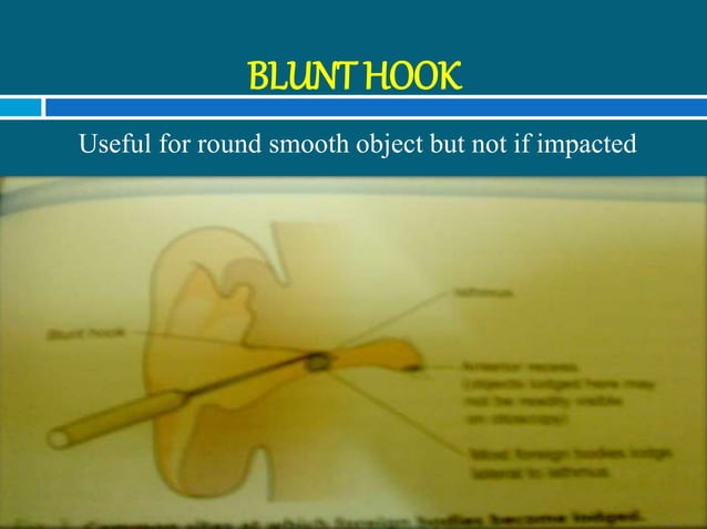 Management of foreignbody in ear | PPTX