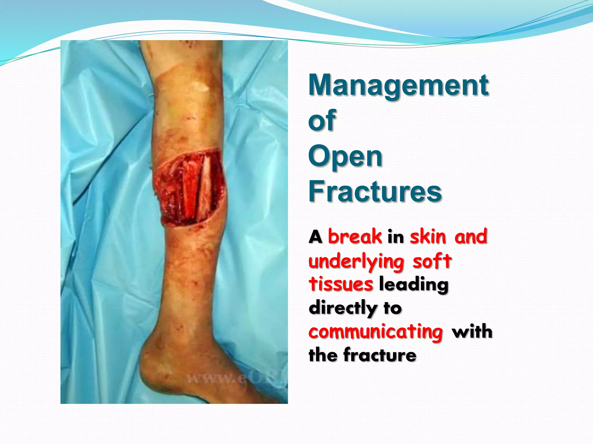 Management of fracture | PPTX
