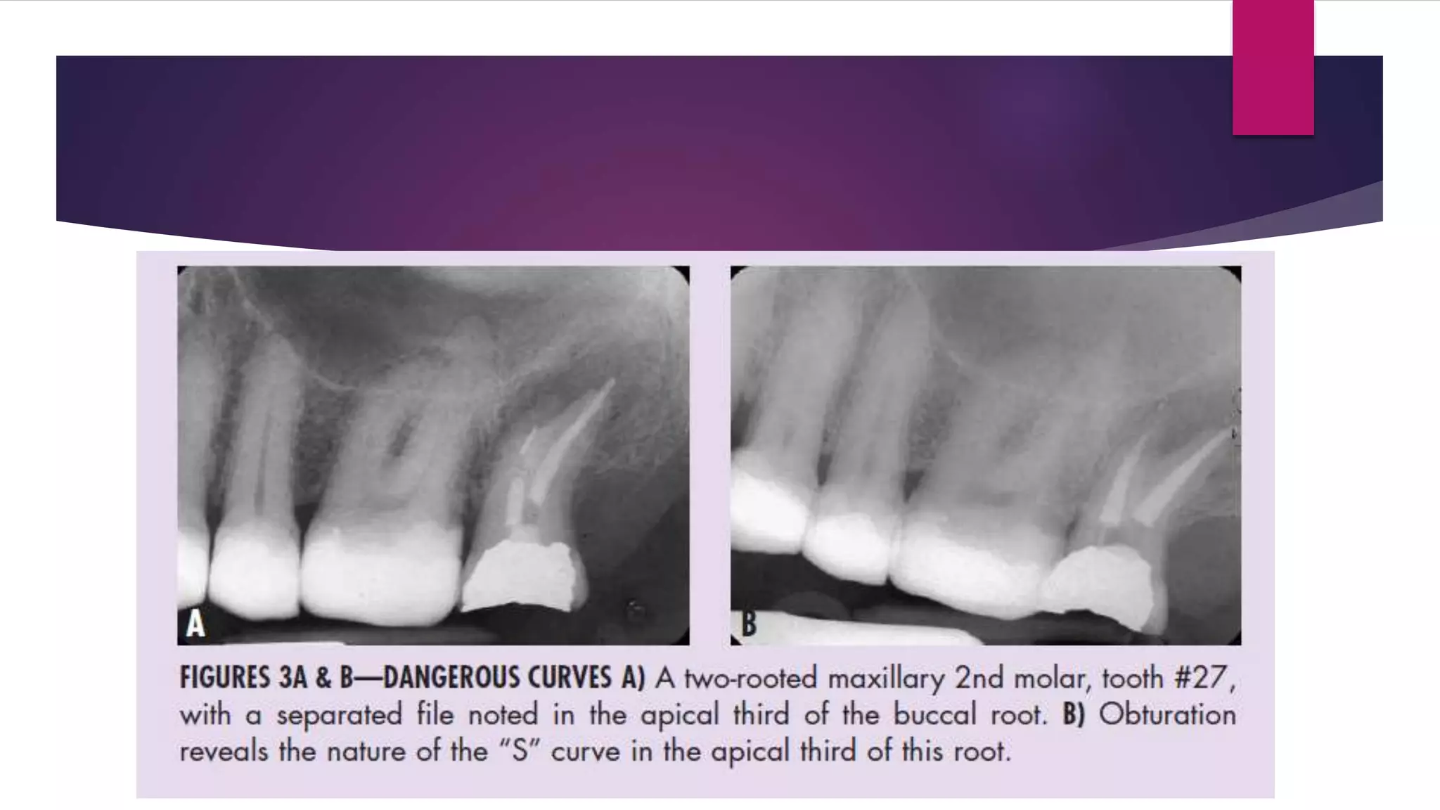 Management of fractured endodontic instruments in root canal | PPTX