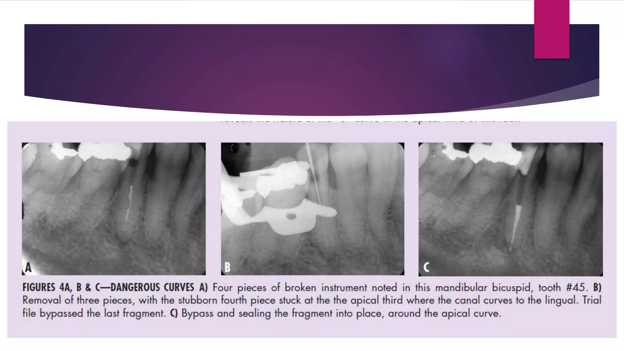 Management of fractured endodontic instruments in root canal | PPT