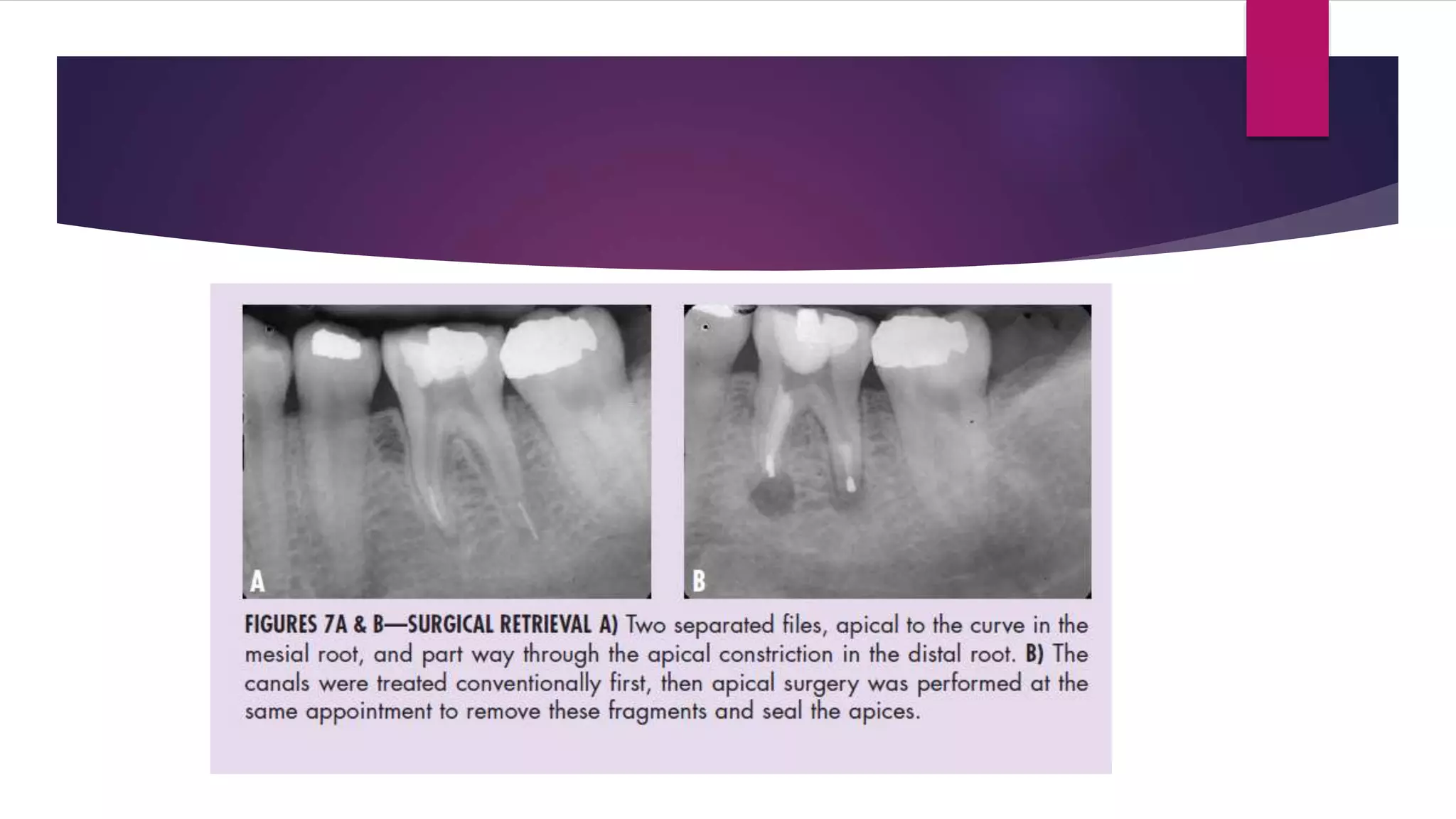 Management of fractured endodontic instruments in root canal | PPTX