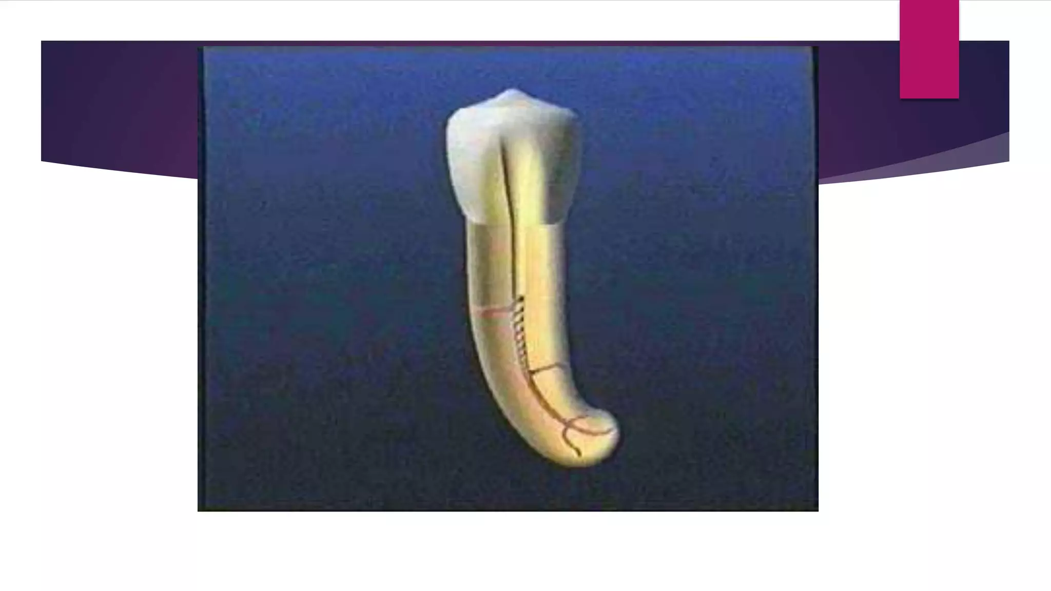 Management of fractured endodontic instruments in root canal | PPTX