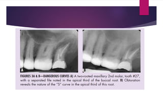 Management of fractured endodontic instruments in root canal | PPTX